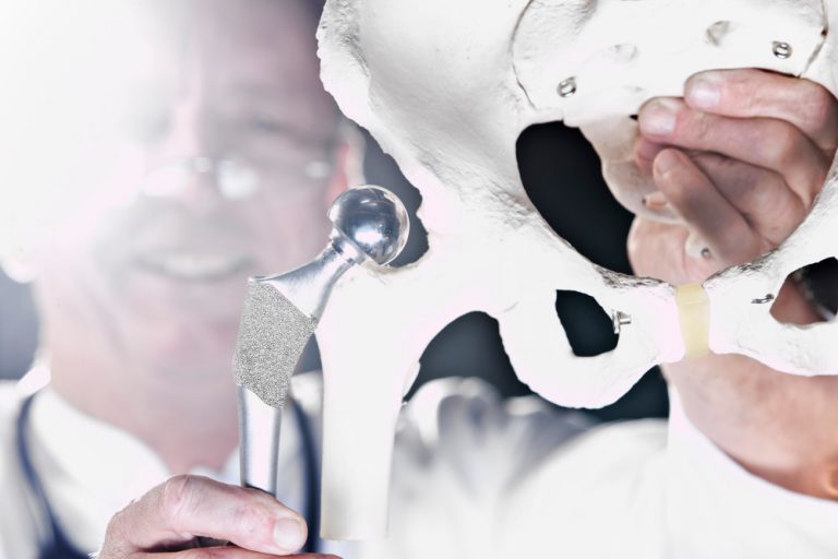 Zwyrodnienie stawu biodrowego - koksartroza - objawy, leczenie i ...