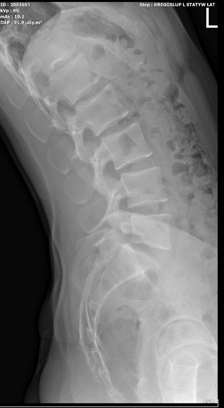 Kręgozmyk – co powinieneś wiedzieć o przesunięciu kręgów?