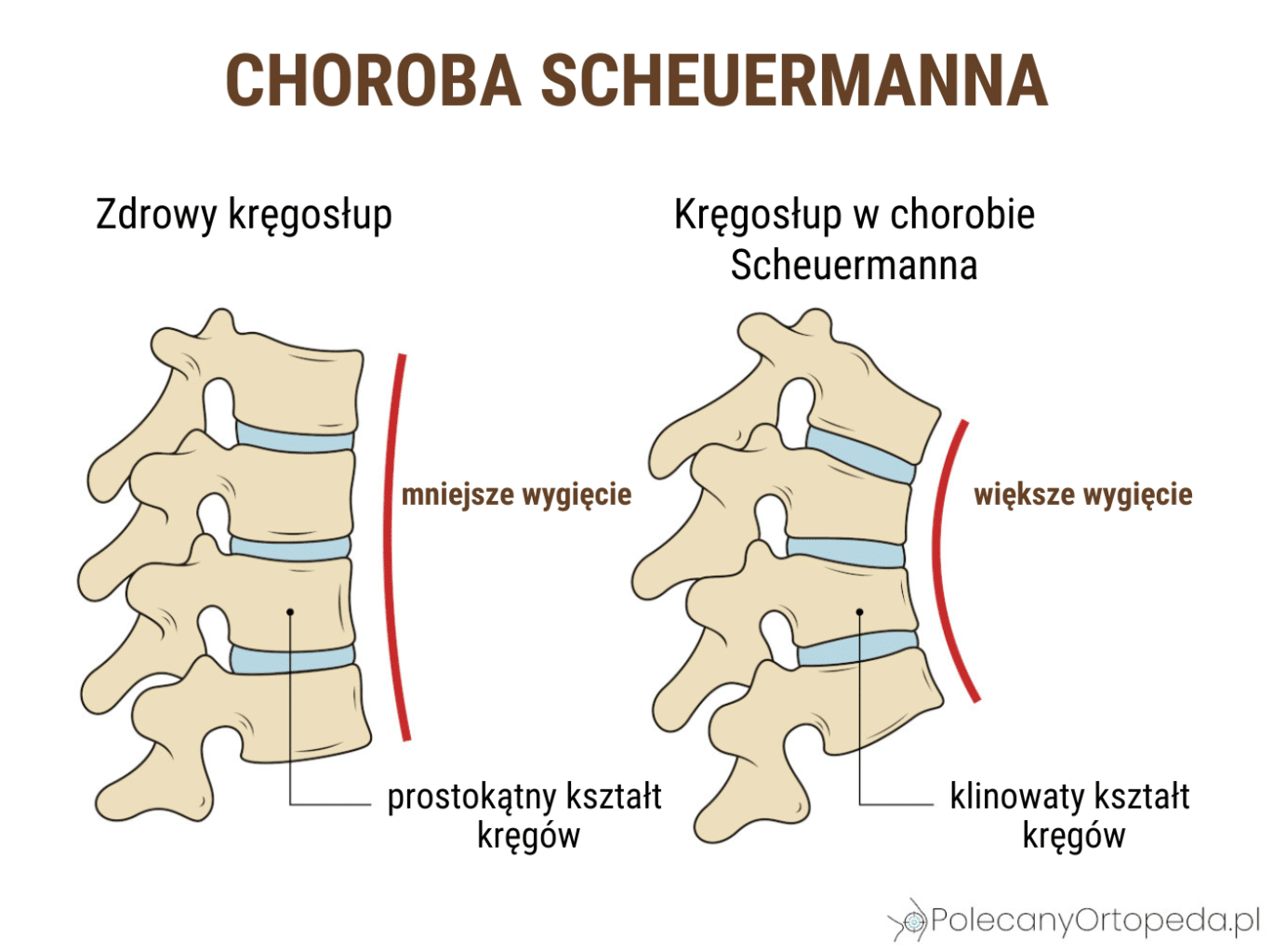 Choroba Scheuermanna – jak się objawia i jak wygląda leczenie?