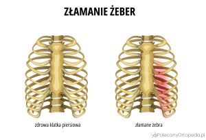 Złamanie żebra - jak wygląda? Objawy, przyczyny i leczenie